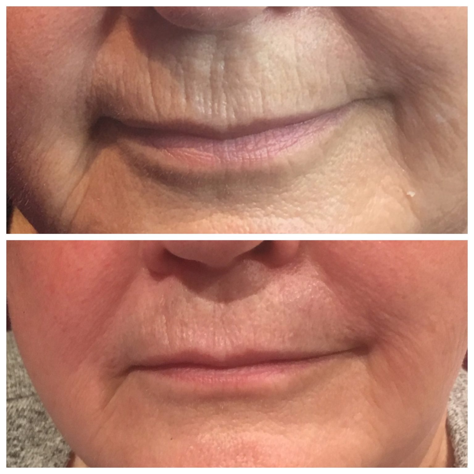 Plasma Lift : avis, danger, efficacité et prix en 2024