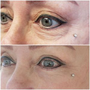 Plasma Lift : avis, danger, efficacité et prix en 2024