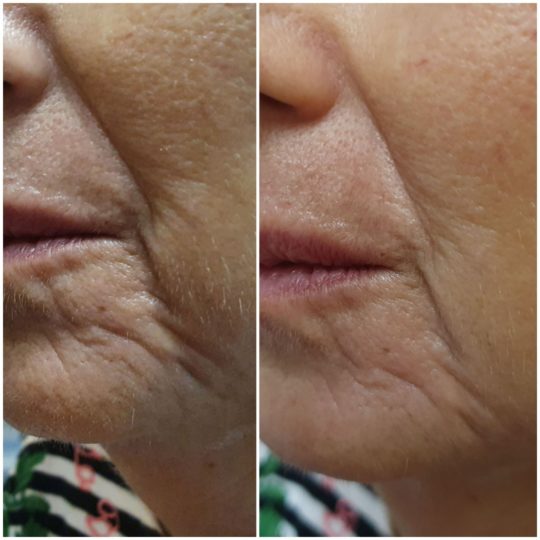 Plasma Lift : avis, danger, efficacité et prix en 2024