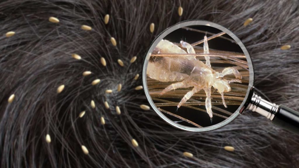 Supprimer les poux radicalement : comment enlever les poux en 1 jour